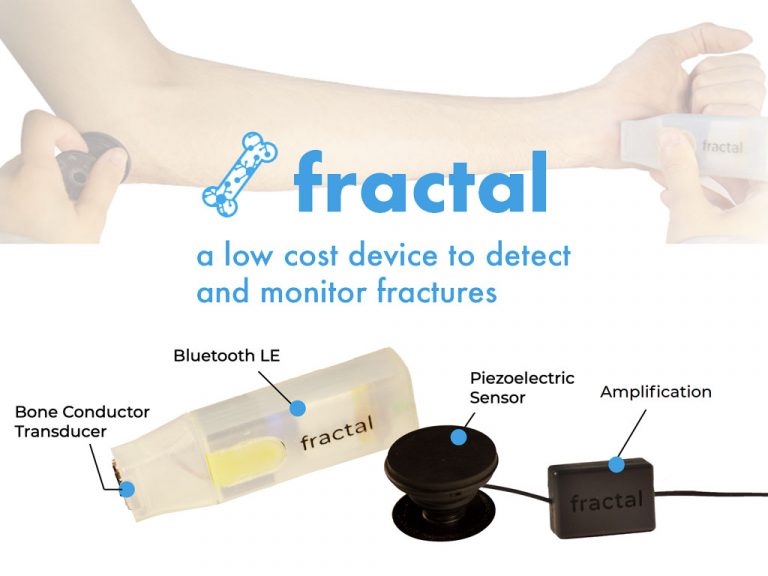Fractal: Acoustic detection and monitoring of bone fractures – Big ...